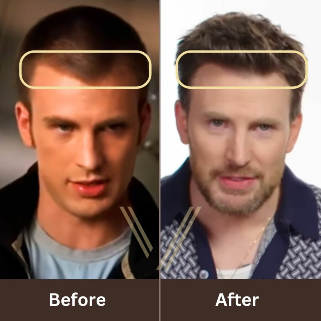 Chris Evans Hair Transplant Before And After Result