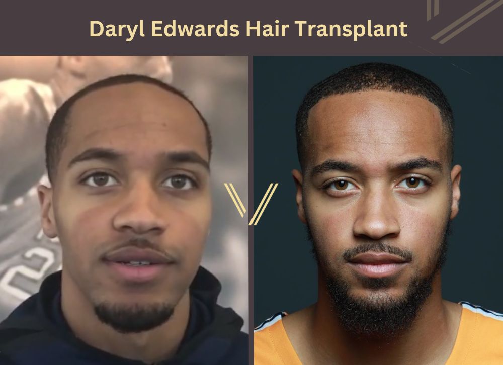 Basketball Players With Hair Transplants | Before and After Photos