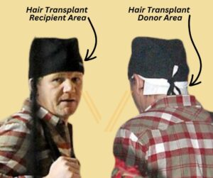 Gordon Ramsay Hair Transplant: Before and After Result
