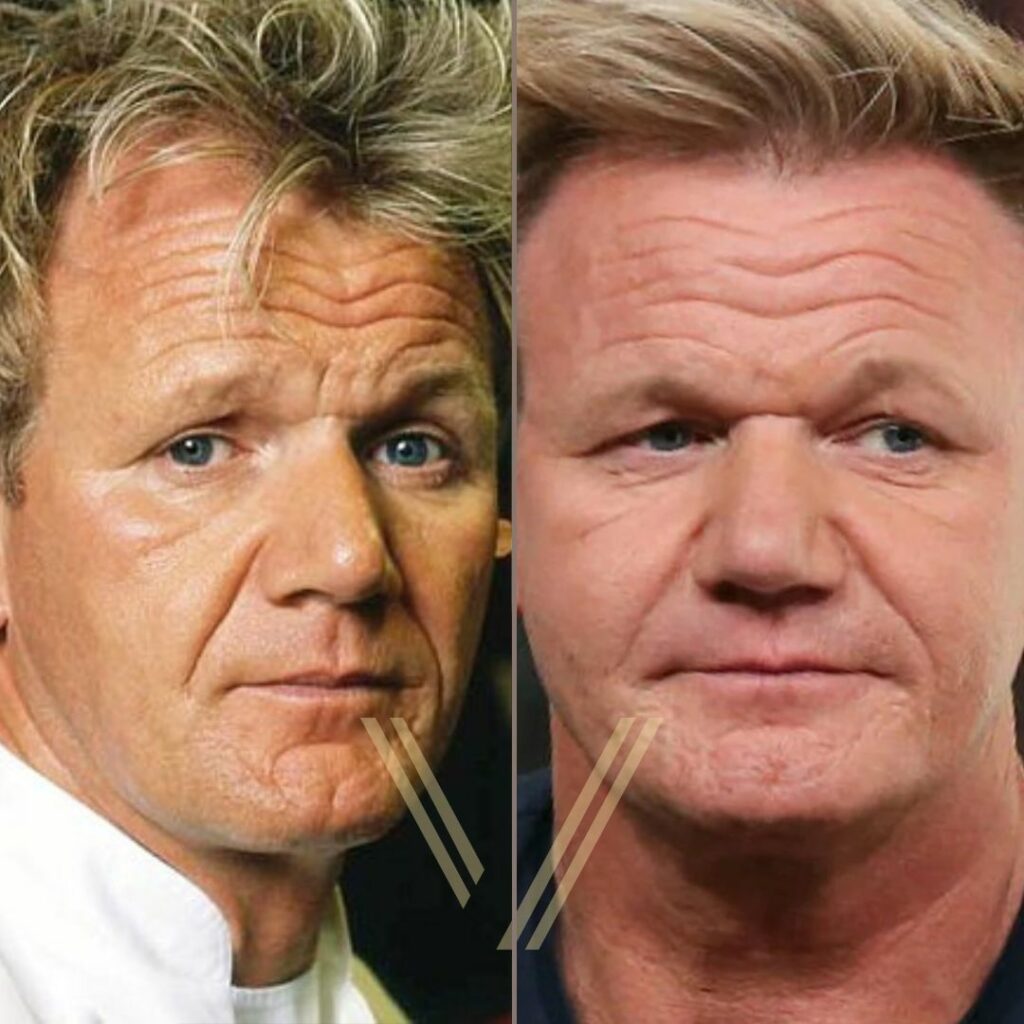 Gordon Ramsay Hair Transplant: Before and After Result