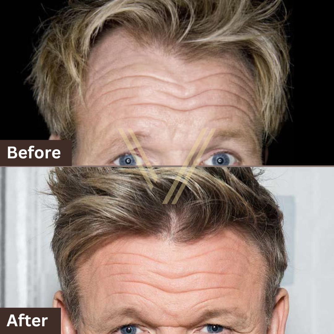 Gordon Ramsay Hair Transplant: Before and After Result