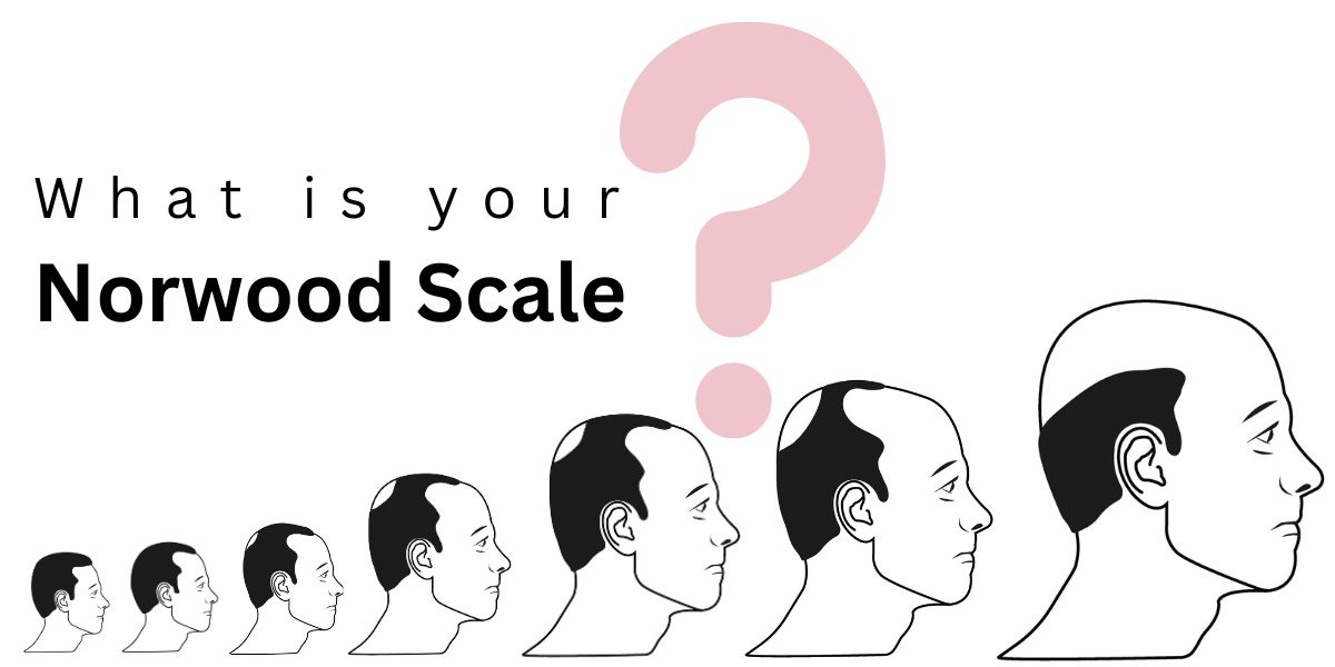 Grafts Required According to Norwood Scales - Vantage Hair Transplant ...