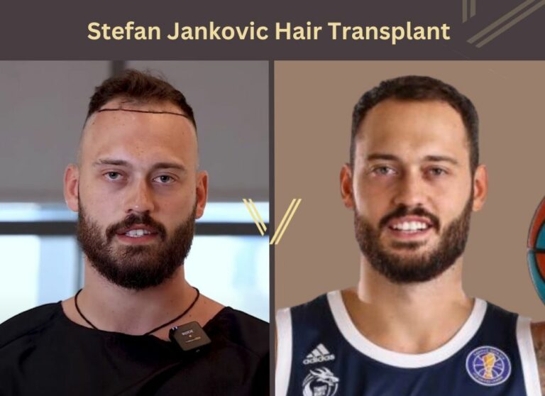 Basketball Players With Hair Transplants | Before and After Photos