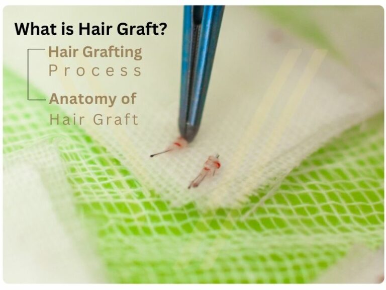 What is a Hair Graft? | Vantage Clinic
