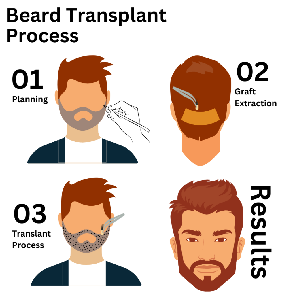 Beard Transplant in Turkey | Procedure & Costs 2025