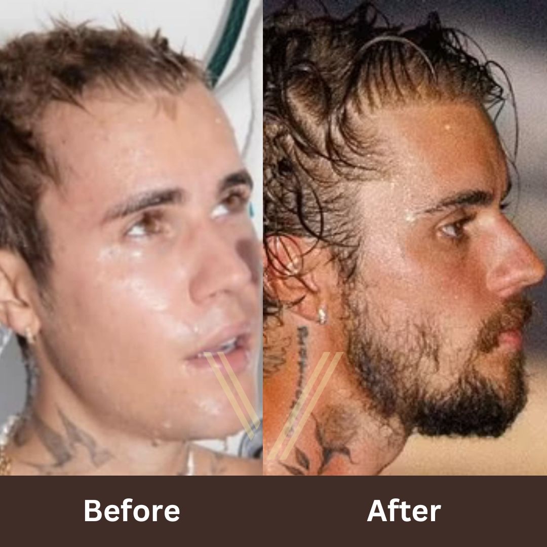 Justin Bieber Hair Transplant Before And After Result
