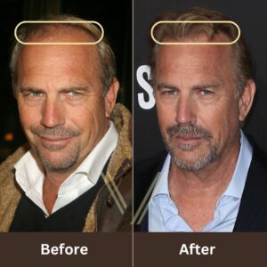Kevin Costner's Hair Transplant: Before and After Result
