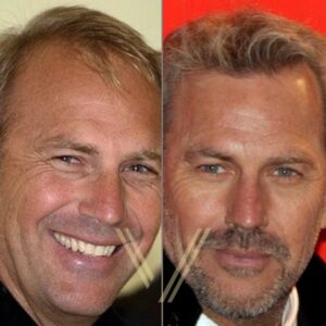 Kevin Costner's Hair Transplant: Before and After Result