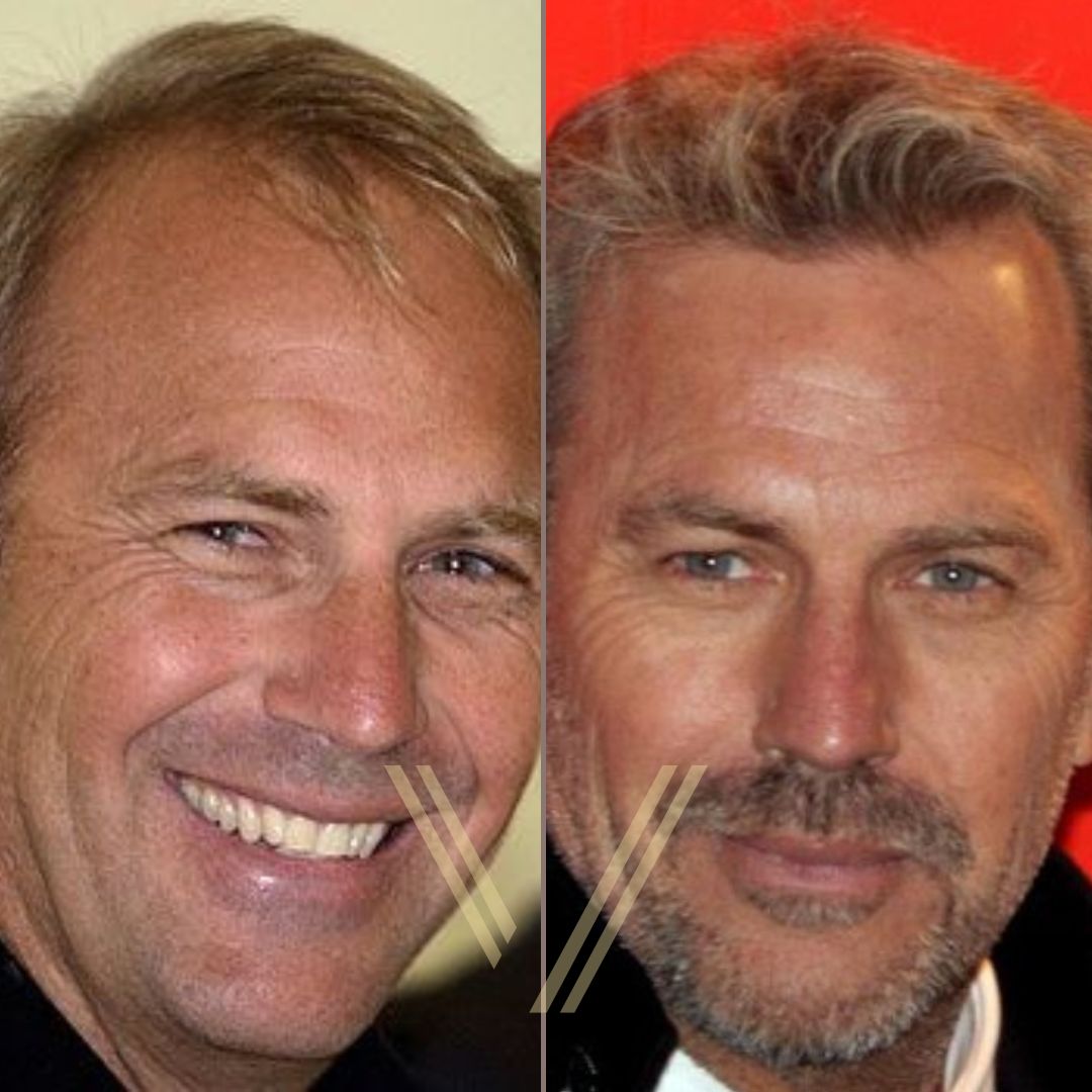 Kevin Costner's Hair Transplant: Before and After Result