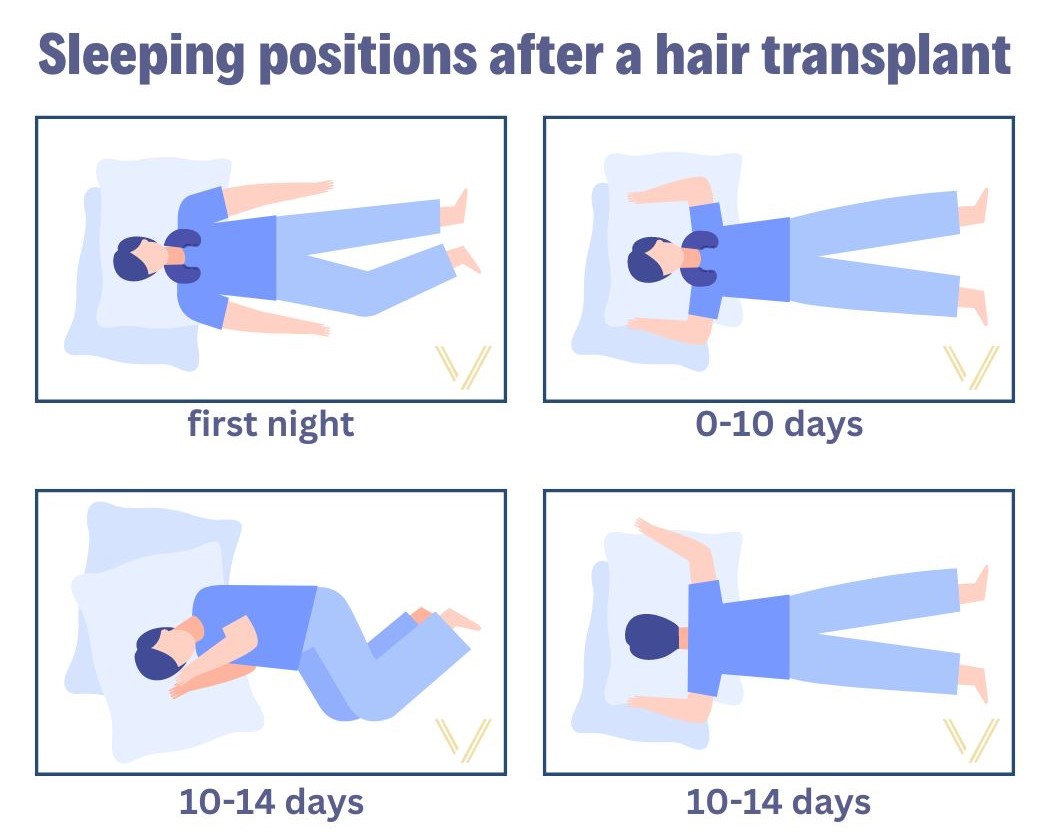 How to sleep after a hair transplant?| Vantage Hair Clinic