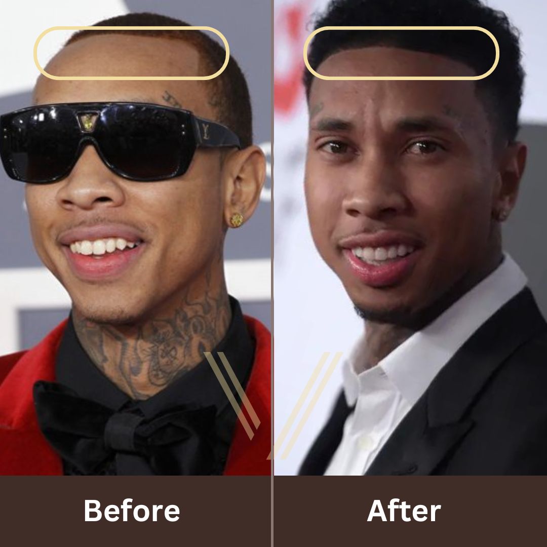Tyga Hair Transplant: Before and After Result