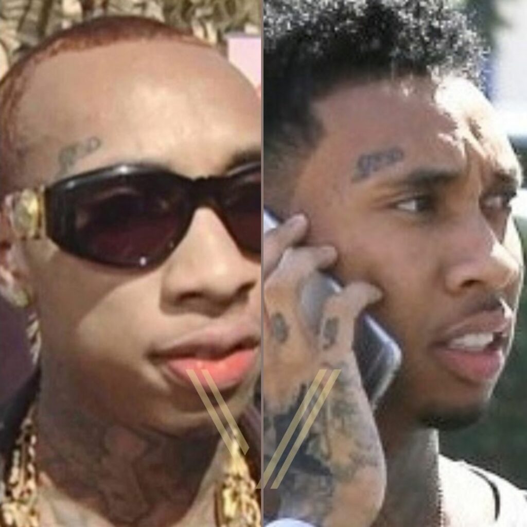 Tyga Hair Transplant: Before and After Result