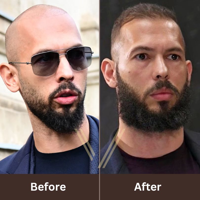 Andrew Tate Hair Transplant