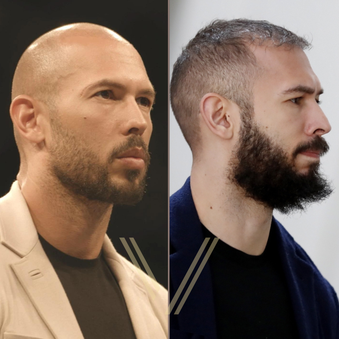 Andrew Tate Hair Transplant: Before and After Result