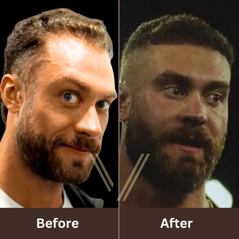 Chris Bumstead's Hair Transplant: Before and After Result
