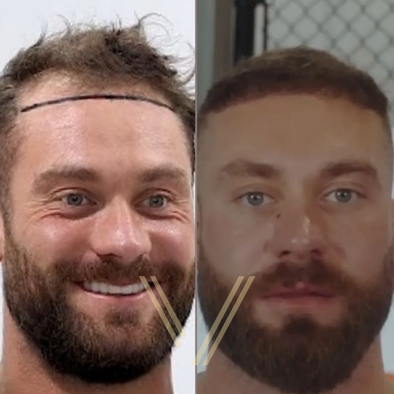 Chris Bumstead's Hair Transplant: Before and After Result