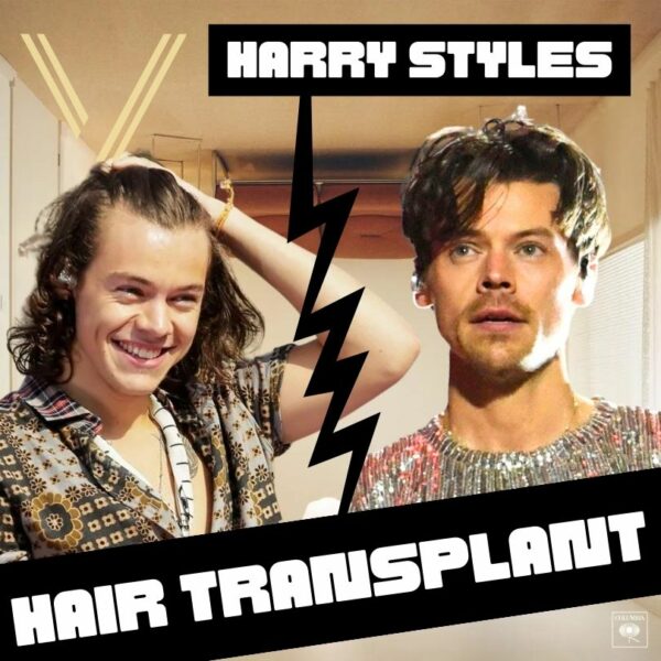 Harry Styles Hair Transplant: Before and After Result