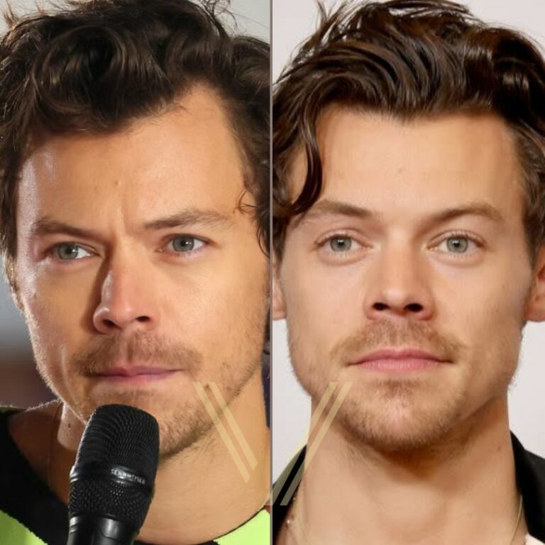 Harry Styles Hair Transplant: Before and After Result