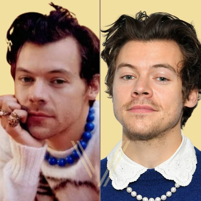 Harry Styles Hair Transplant: Before and After Result