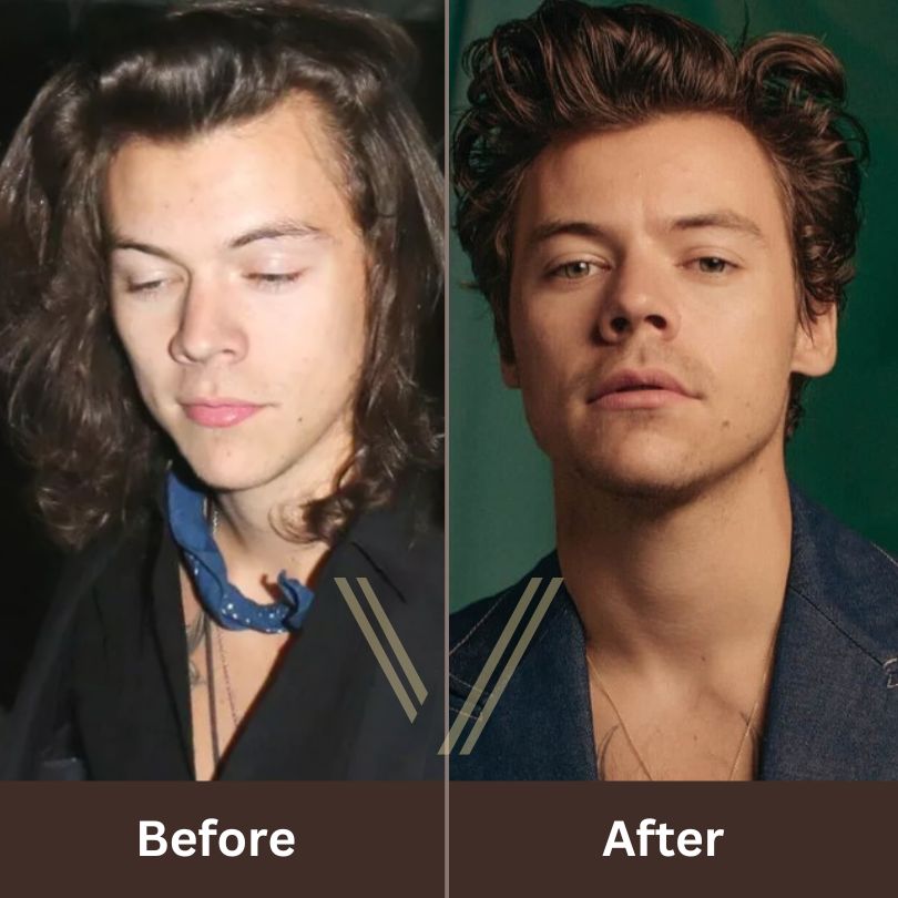 Harry Styles Hair Transplant: Before and After Result