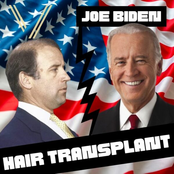 Joe Biden Hair Transplant: Before and After Result