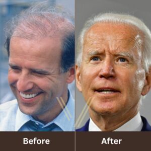 Joe Biden Hair Transplant: Before and After Result