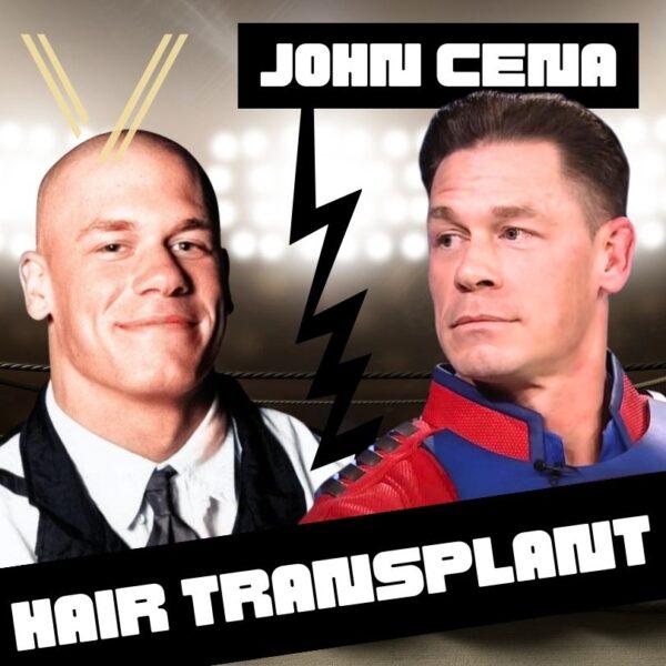 John Cena Hair Transplant: Before and After Result