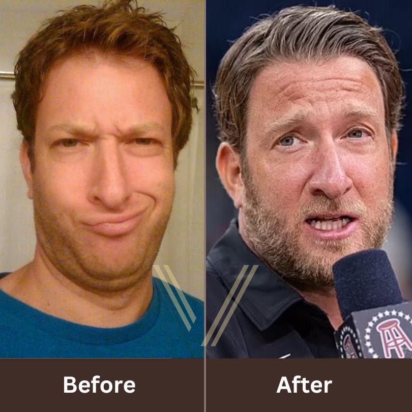 Dave Portnoy Hair Transplant
