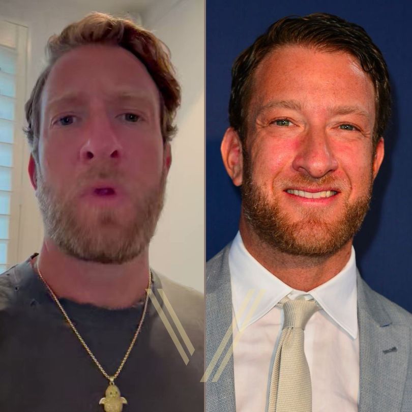 Dave Portnoy Hair Transplant