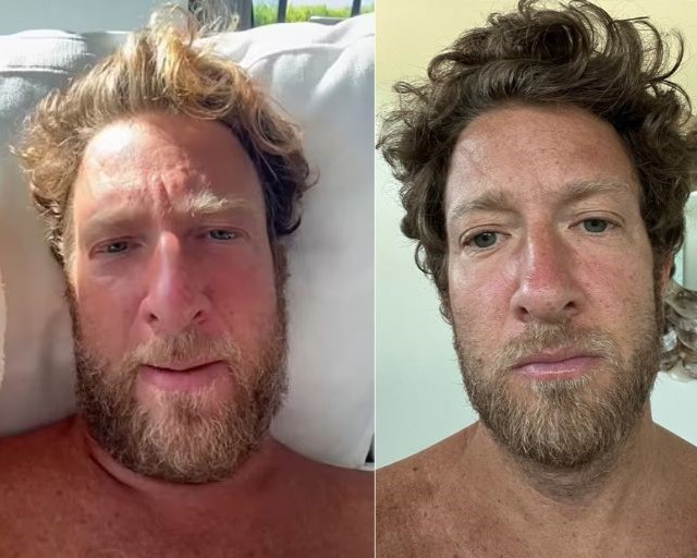 Dave Portnoy Hair Transplant