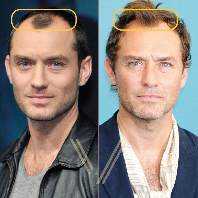 Jude Law Hair Transplant: Before and After Result