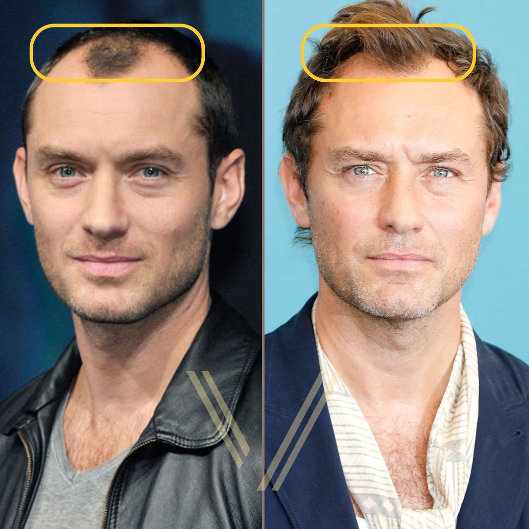 Jude Law Hair Transplant: Before and After Result