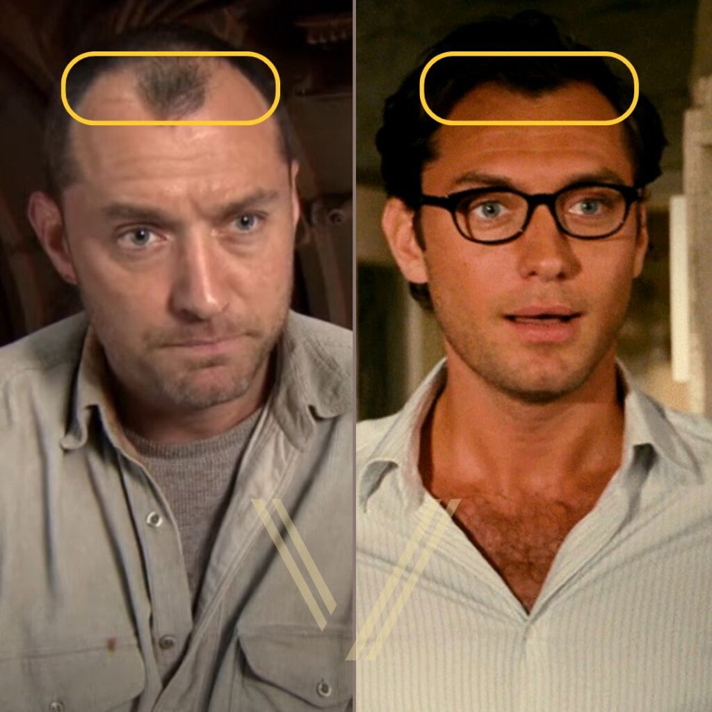 Jude Law Hair Transplant: Before and After Result