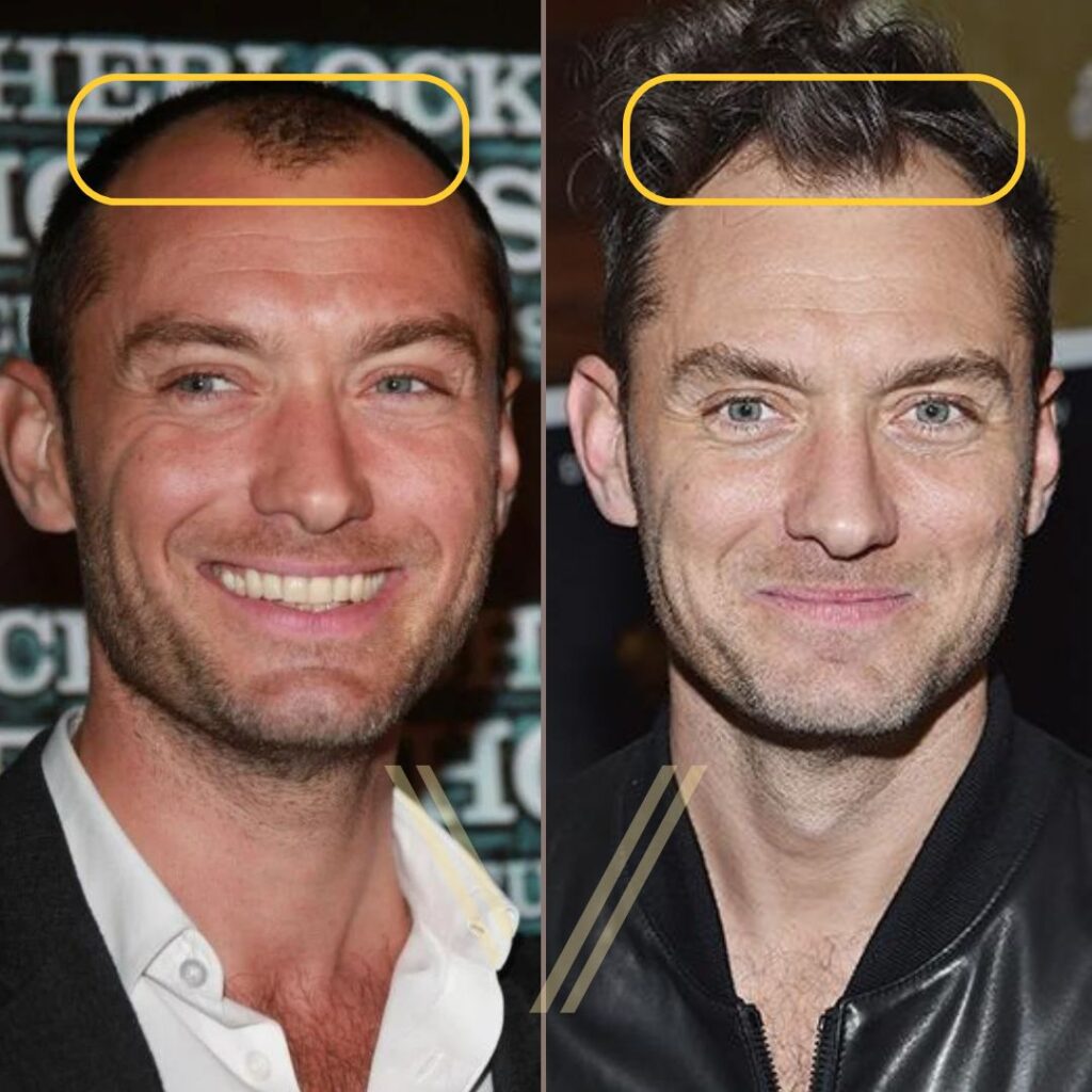 Jude Law Hair Transplant: Before and After Result