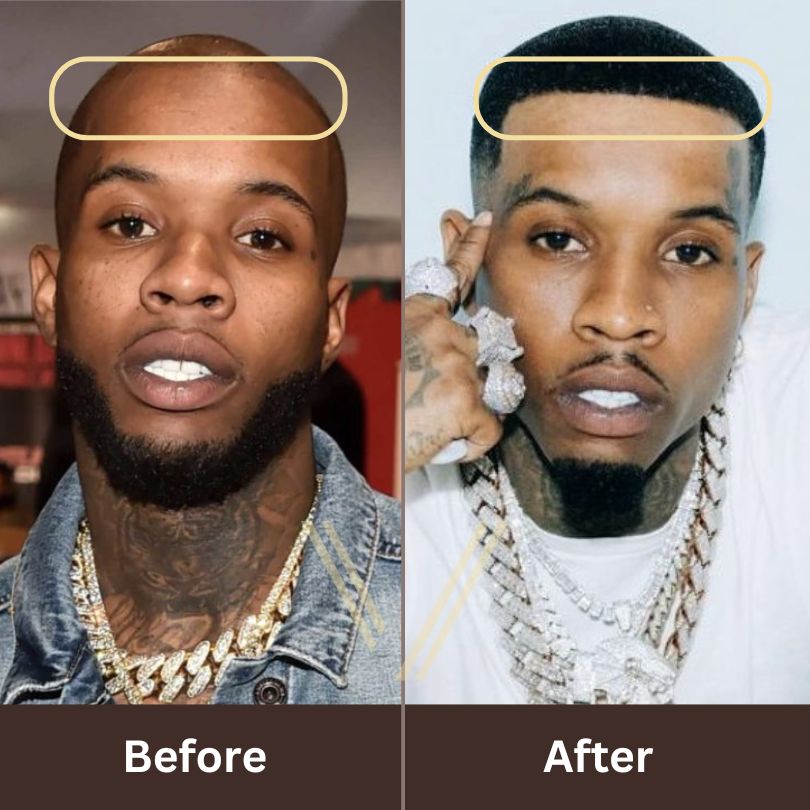 Tory Lanez Hair Transplant: Before and After Result