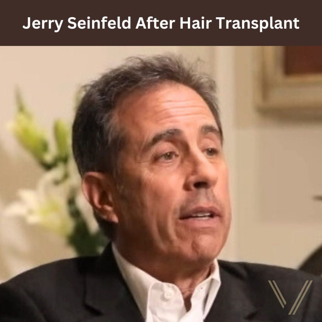 Jerry Seinfeld Hair Transplant: Before and After Result