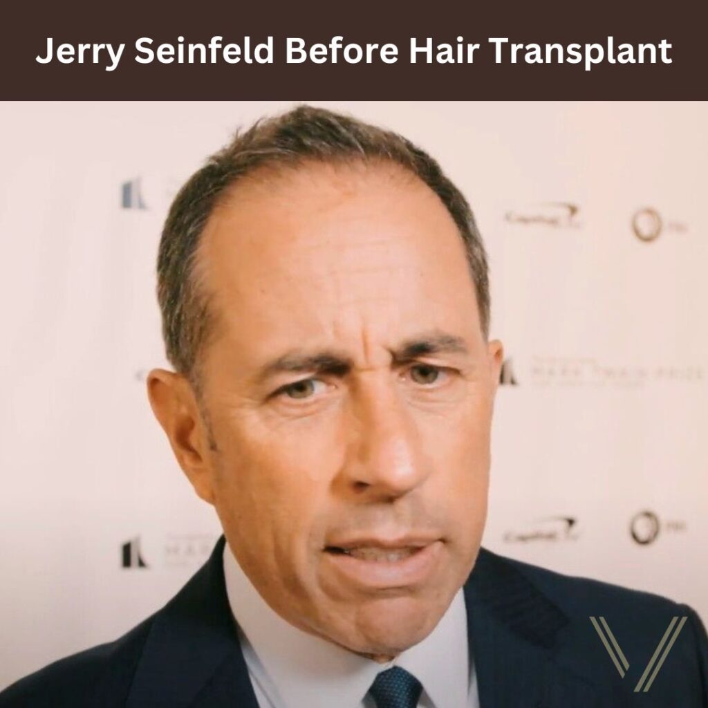 Jerry Seinfeld Hair Transplant: Before and After Result