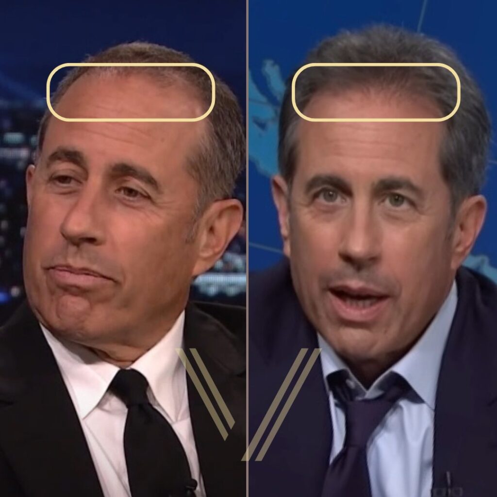 Jerry Seinfeld Hair Transplant: Before and After Result
