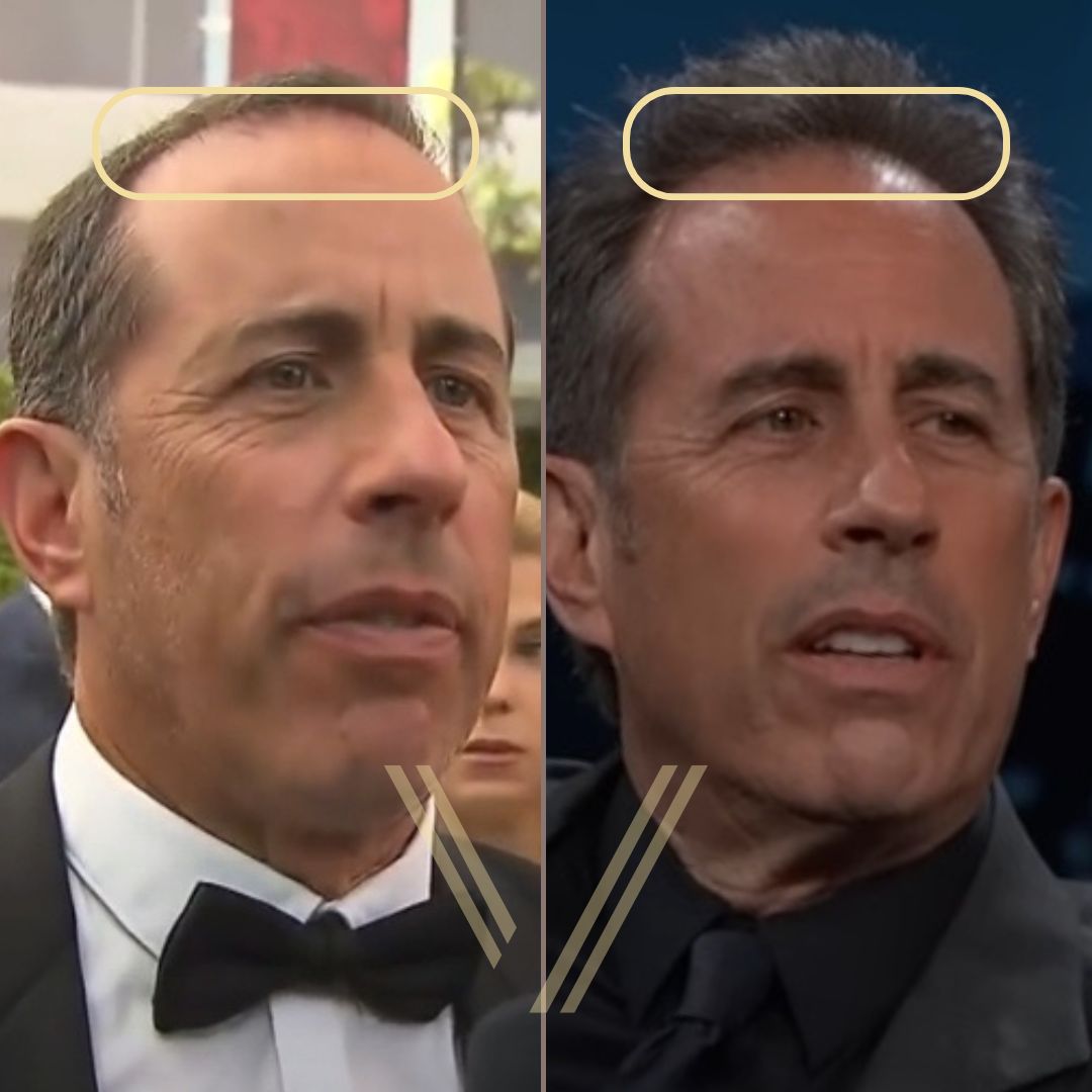 Jerry Seinfeld Hair Transplant: Before and After Result