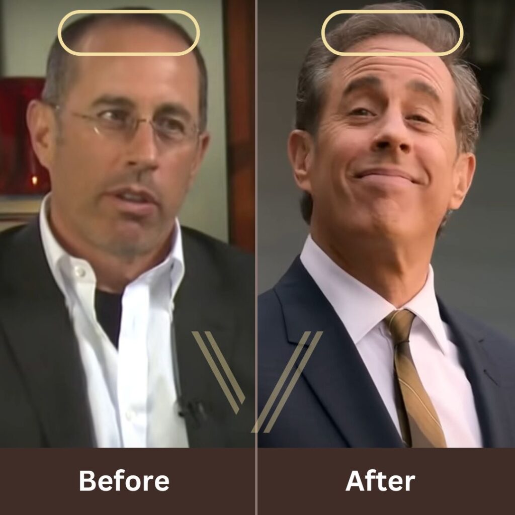 Jerry Seinfeld Hair Transplant: Before and After Result
