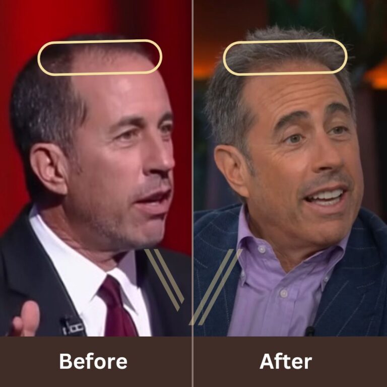 Jerry Seinfeld Hair Transplant: Before and After Result