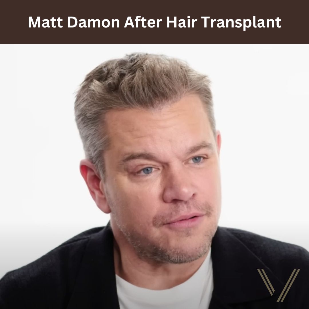 Matt Damon Hair Transplant: Before and After Result