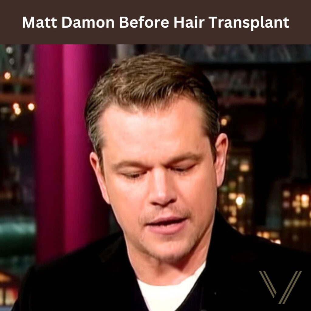 Matt Damon Hair Transplant: Before and After Result