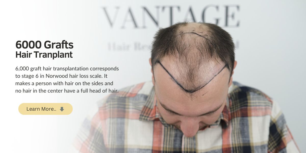 6000 Grafts Hair Transplant in Turkey | 2025 Costs | Vantage Clinic