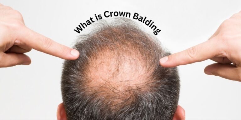 Crown Balding - Causes and Treatments