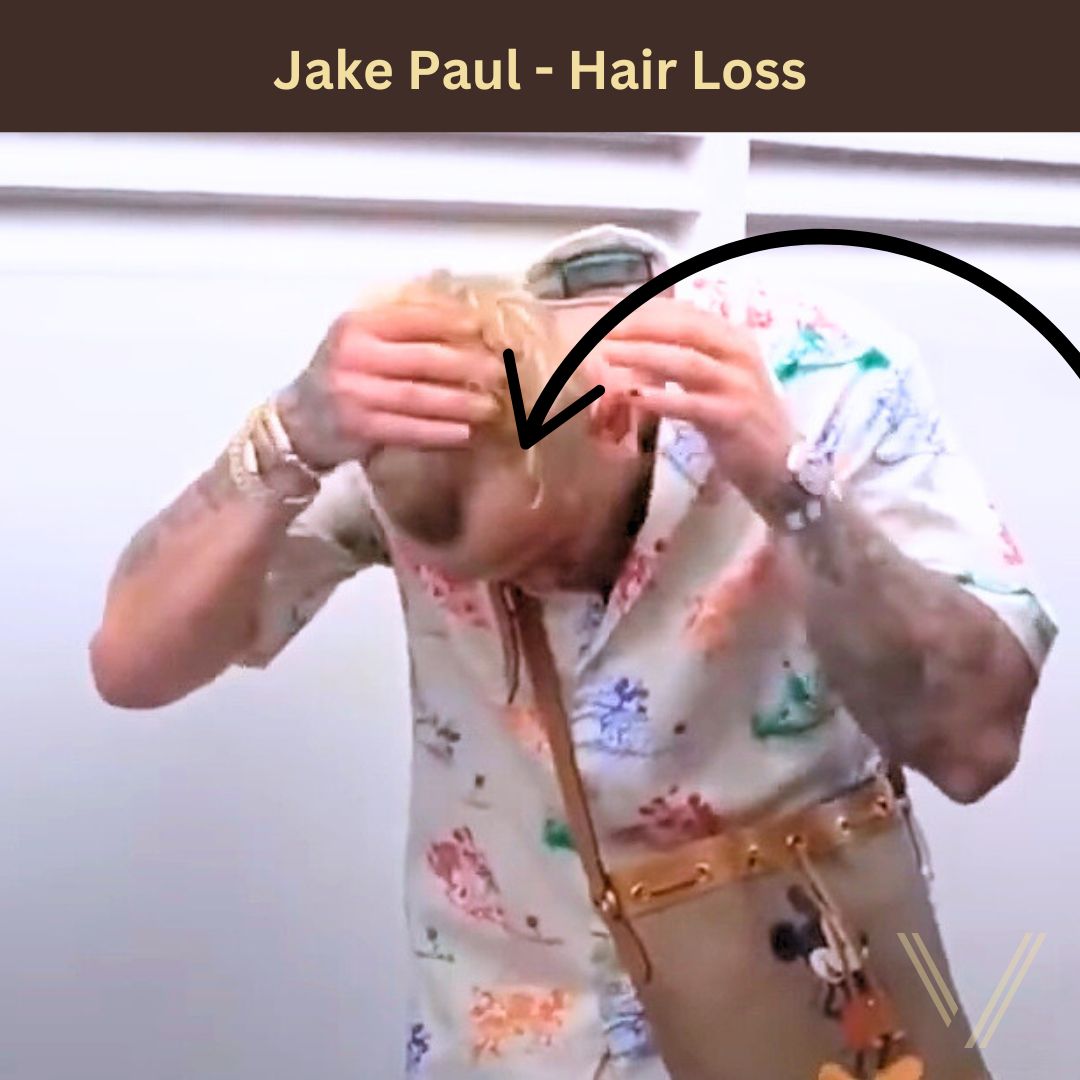 Jake Paul Hair Transplant - Before and After