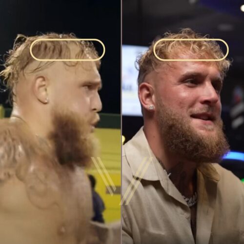 Jake Paul Hair Transplant - Before and After