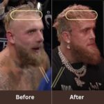 Jake Paul Hair Transplant - Before and After