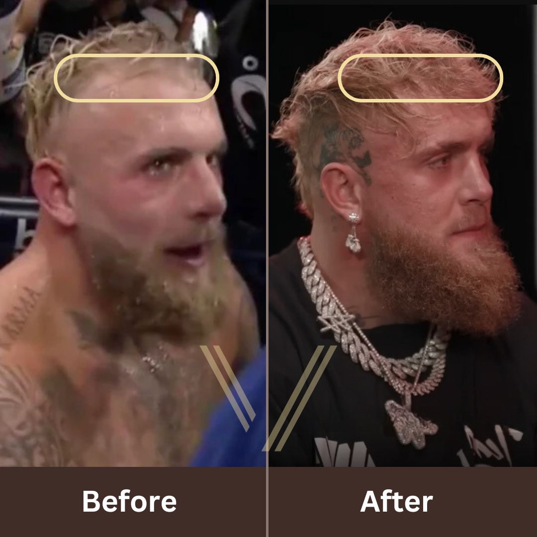 Jake Paul Hair Transplant - Before and After
