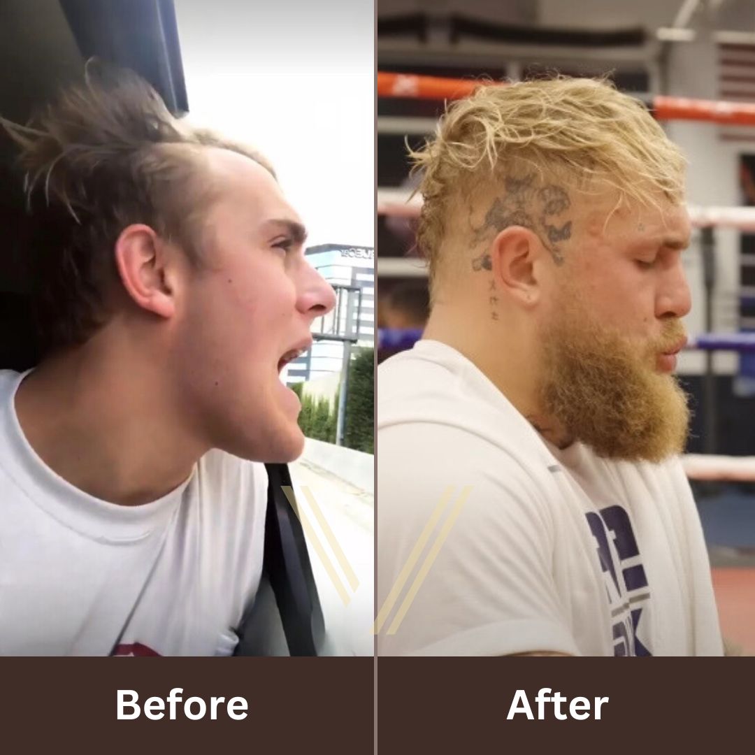 Jake Paul Hair Transplant - Before and After